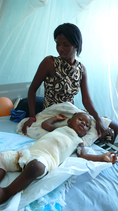 The baby with burn wound | MSF Hong Kong